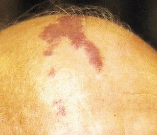 How to Live With A Birthmark? - Medpundit